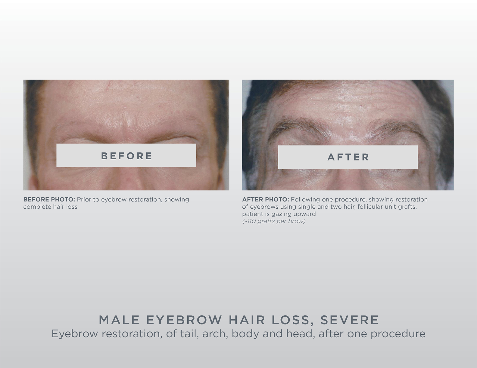 Gallery | GL Perrault MD | Hair Loss and Hair Restoration