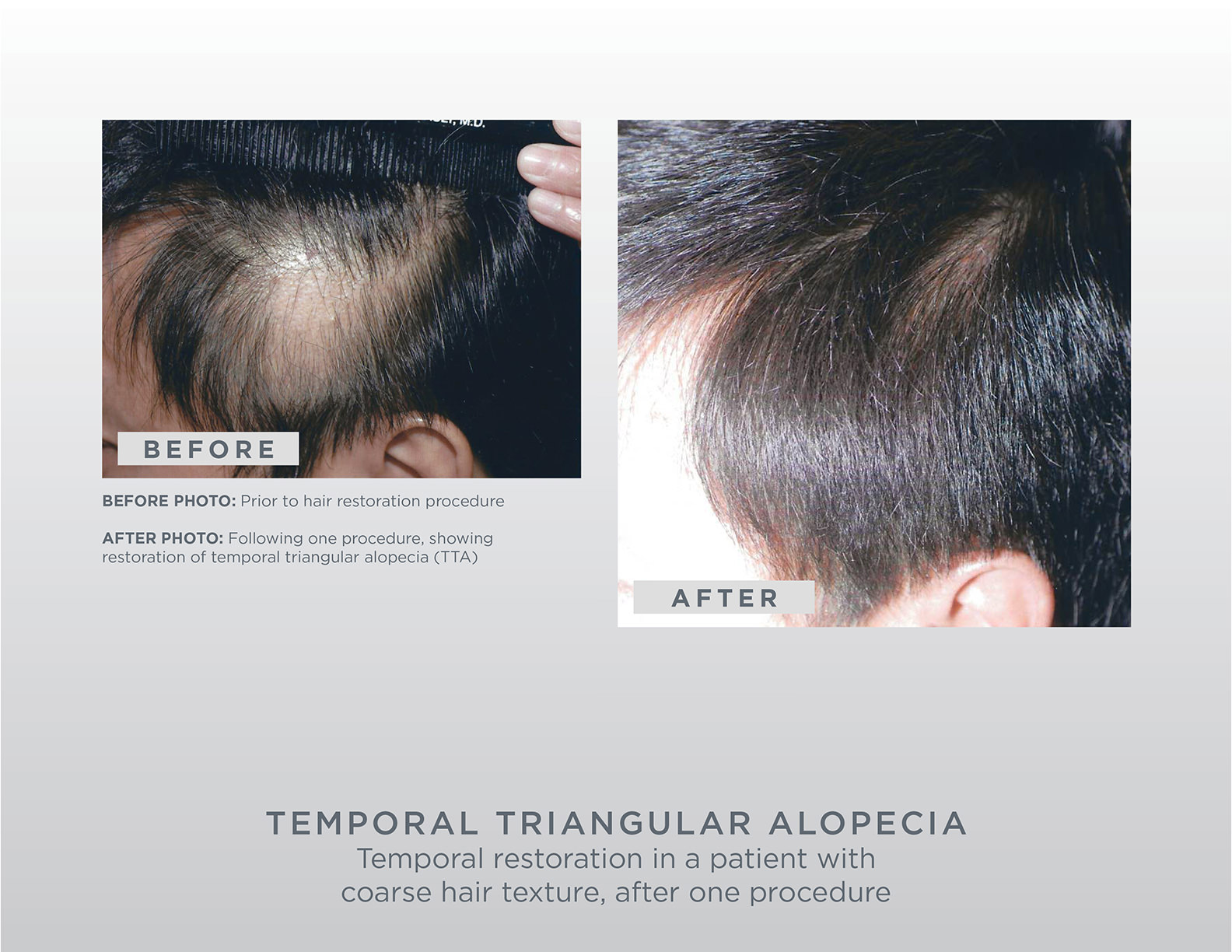 Gallery | GL Perrault MD | Hair Loss and Hair Restoration