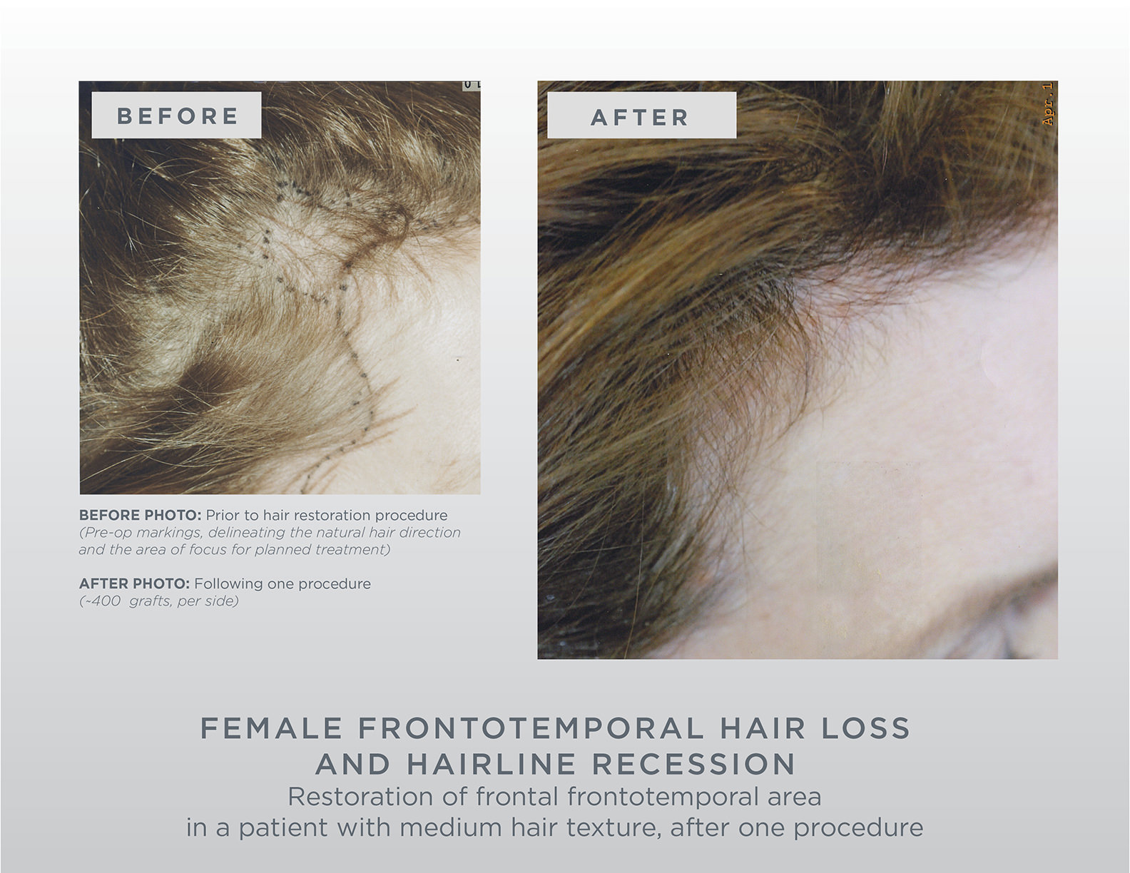 Gallery | GL Perrault MD | Hair Loss and Hair Restoration