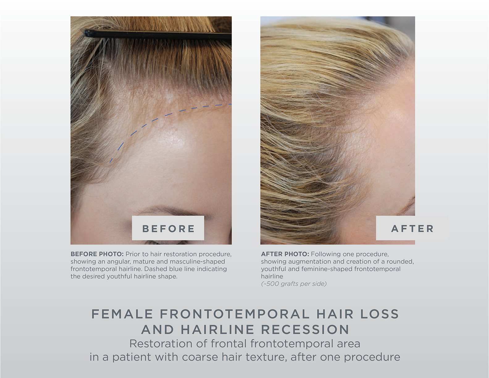 Gallery | GL Perrault MD | Hair Loss and Hair Restoration