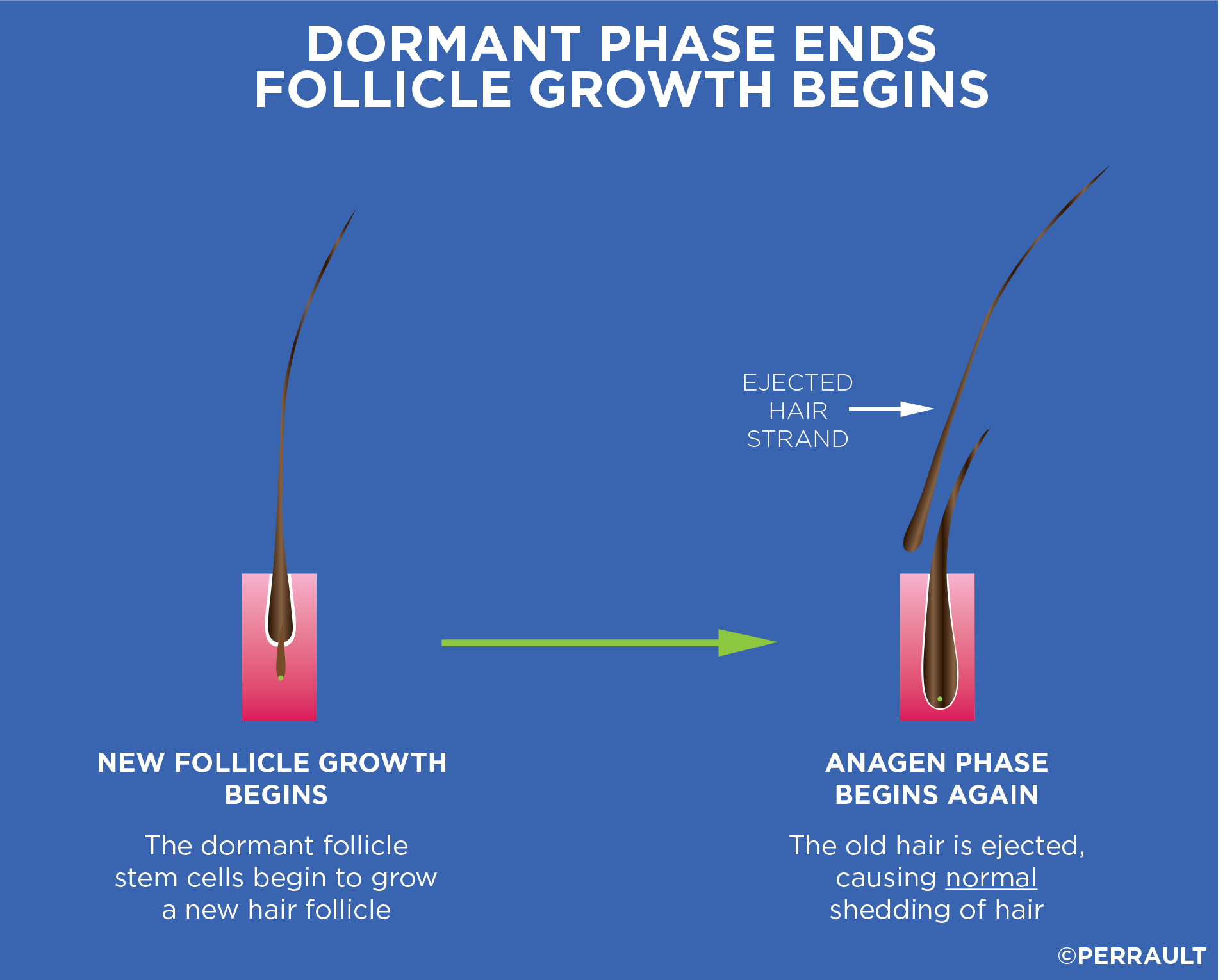 Hair Growth Cycle Gl Perrault Md Hair Loss And Hair Restoration