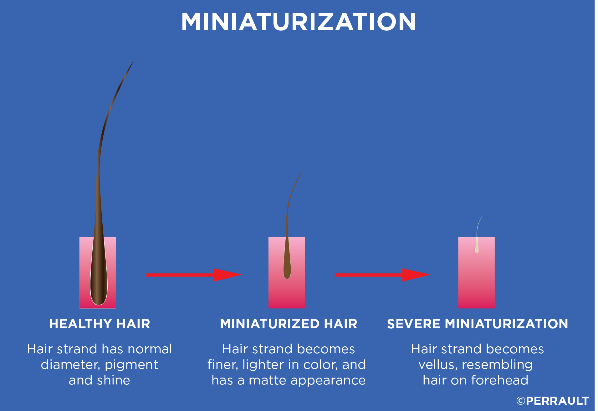 Hair Loss In Men Gl Perrault Md Hair Loss And Hair Restoration